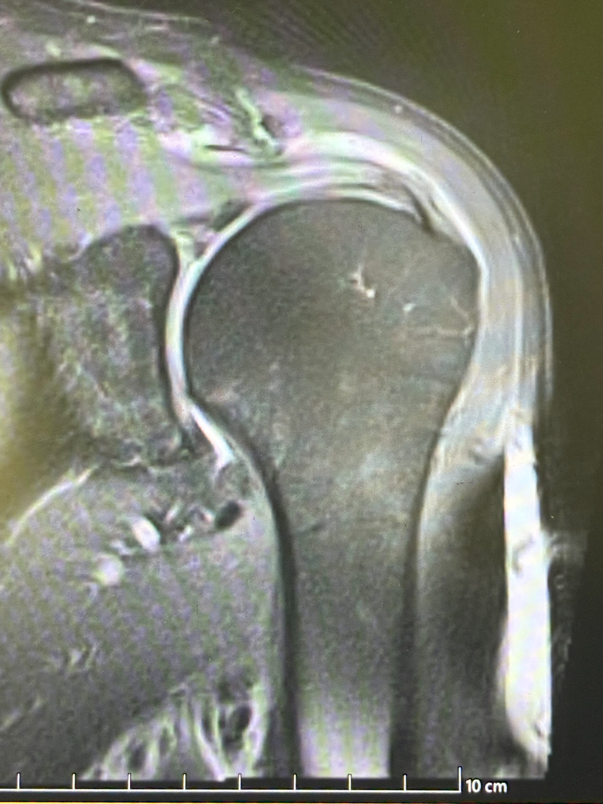 My Shoulder MRI Is Normal. Could There Still Be Something Wrong ...